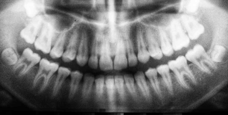 Détectez vos infections dentaires | Rhône Dental Clinic